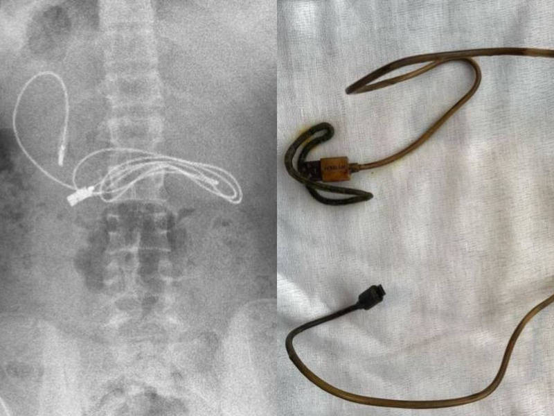 Abdominal Pain And Vomiting X ray 15 year old Boy Stuck In Stomach With 